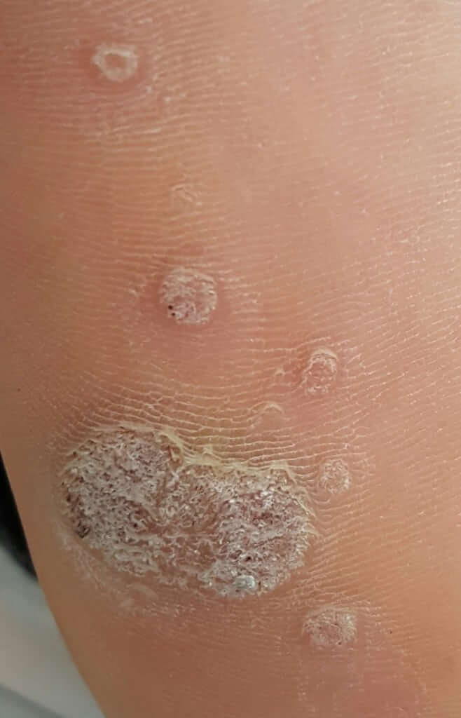 Plantar wart/verrucae - OC Podiatry