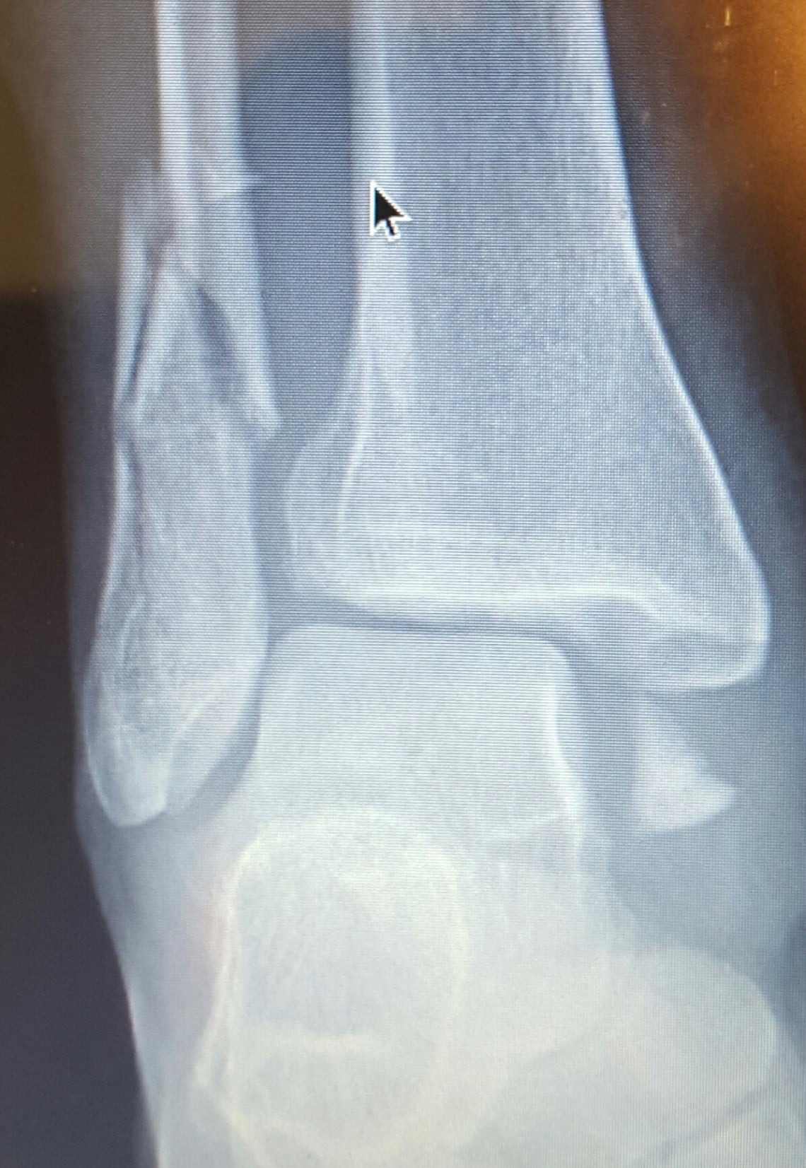 Ankle Fracture - OC Podiatry