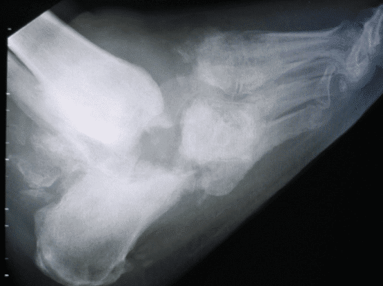 Charcot Foot - OC Podiatry