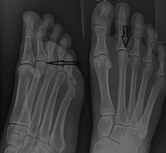 Osteochondral Defect Treatment of the Foot and Ankle