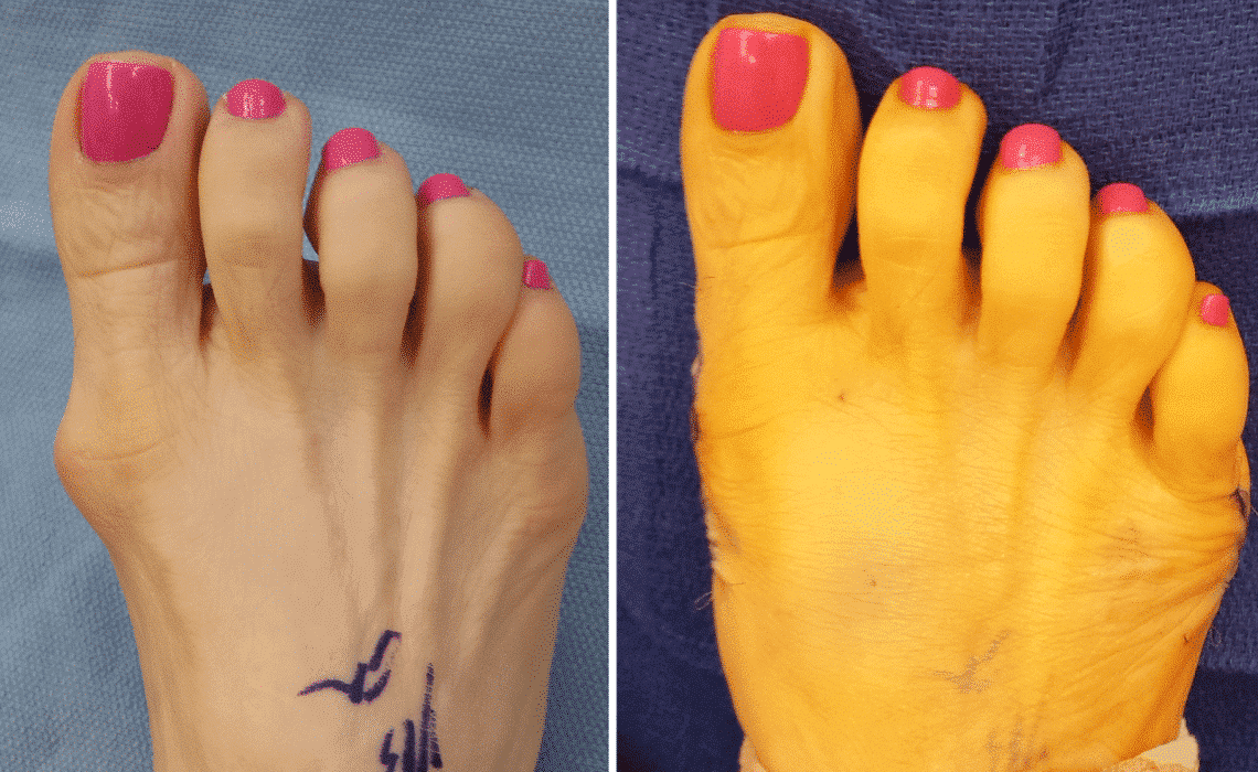 Bunion Surgery Orange County Irvine Southern California