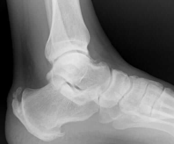 Haglund’s Deformity - OC Podiatry