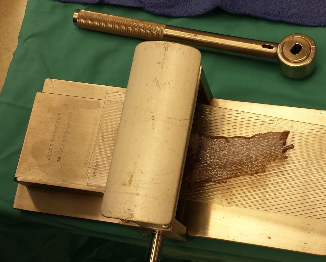 Skin Graft Surgery Orange County