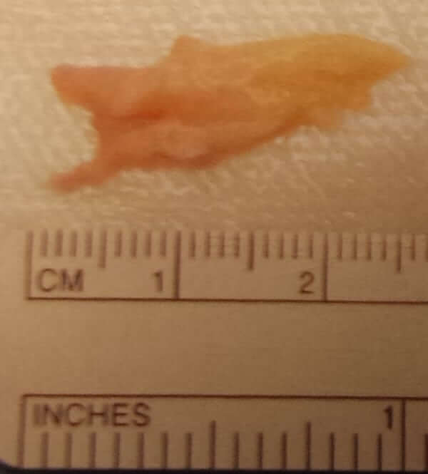 Morton’s Neuroma - OC Podiatry