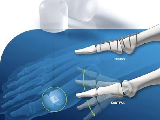 Cartiva Joint Replacement Orange County - OC Podiatry