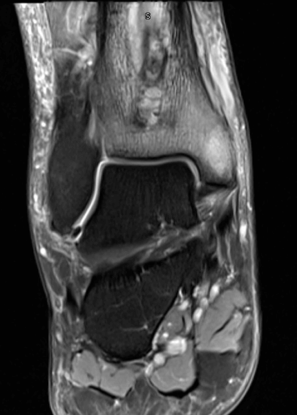 Brodie’s Abscess - OC Podiatry