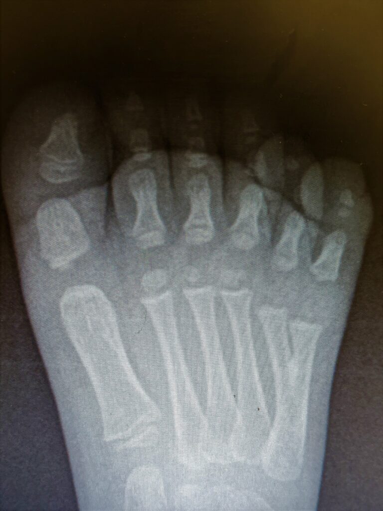 Polydactyly Surgery Orange County